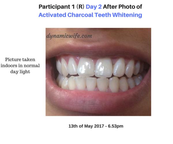 Activated Charcoal Teeth Whitening Experiment -2 REAL Before/After Pics